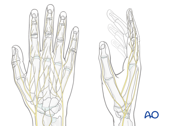 Digital nerve lesions in the hand