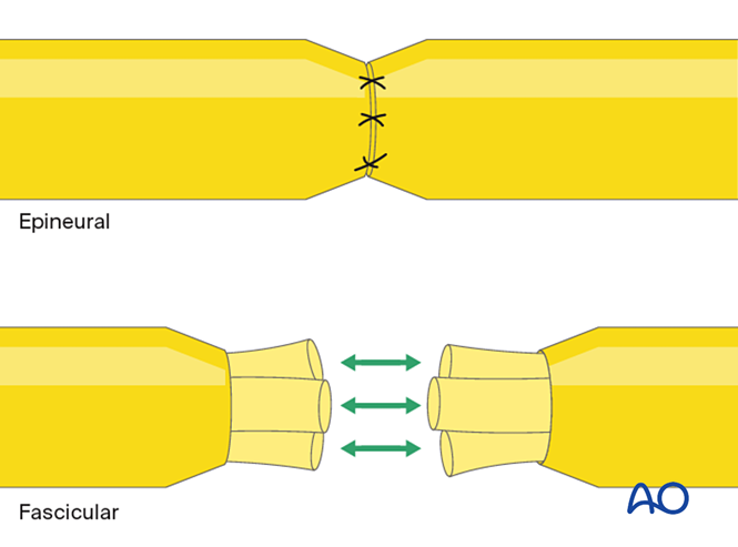 Ulnar and median nerve lesions