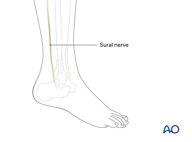 Digital nerve lesions in the hand