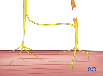 Digital nerve lesions in the hand