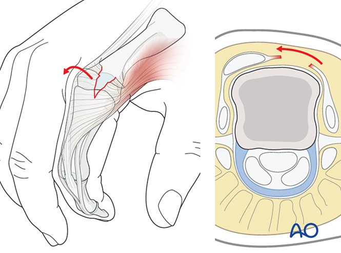 Ligament injuries of the hand