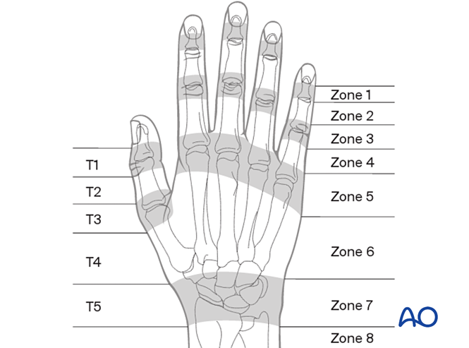 Extensor tendon mechanism