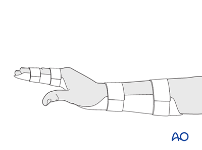 Extensor tendon mechanism