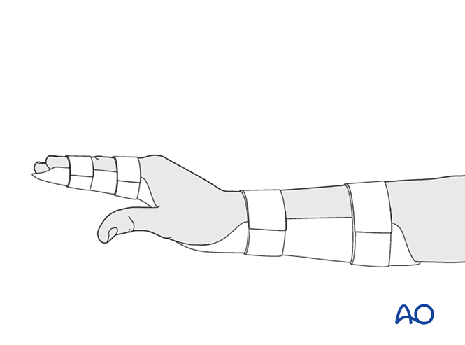 Extensor tendon mechanism