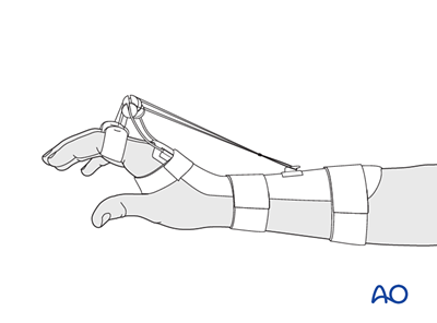 Extensor tendon mechanism
