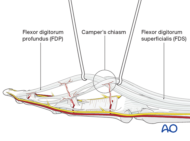 Flexor tendon mechanism