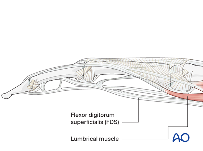 Flexor tendon mechanism