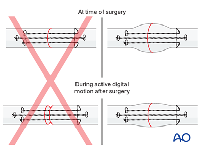 Flexor tendon mechanism
