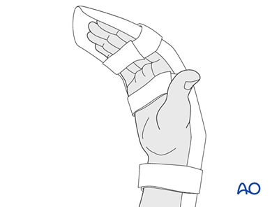 Flexor tendon mechanism