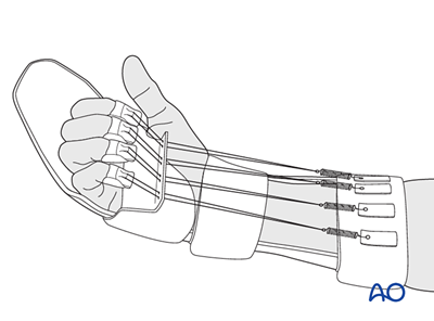 Flexor tendon mechanism