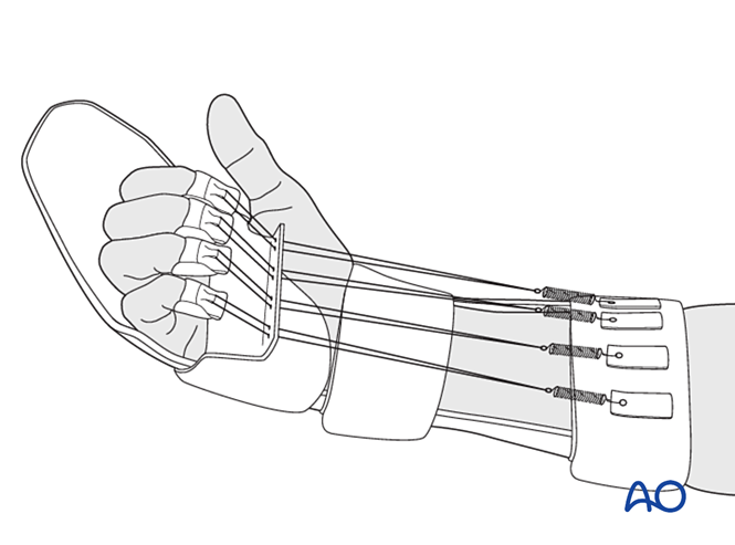 Flexor tendon mechanism