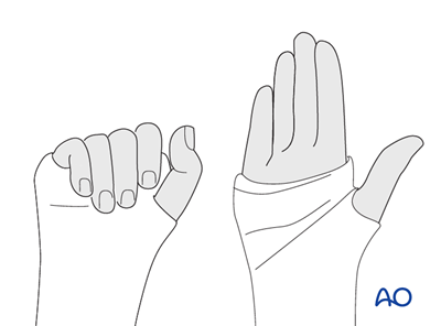 Nonoperative treatment for Scaphoid, waist