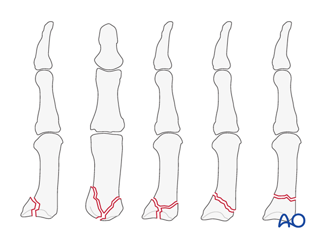 Radiopalmar approach to the base of the thumb