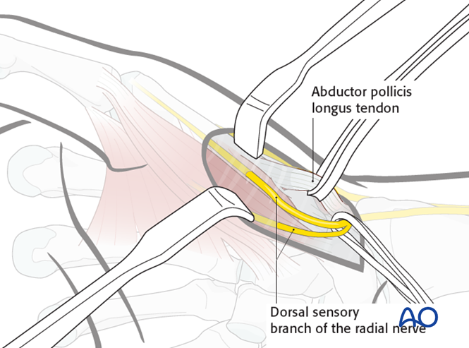 Radiopalmar approach to the base of the thumb