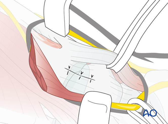 Radiopalmar approach to the base of the thumb