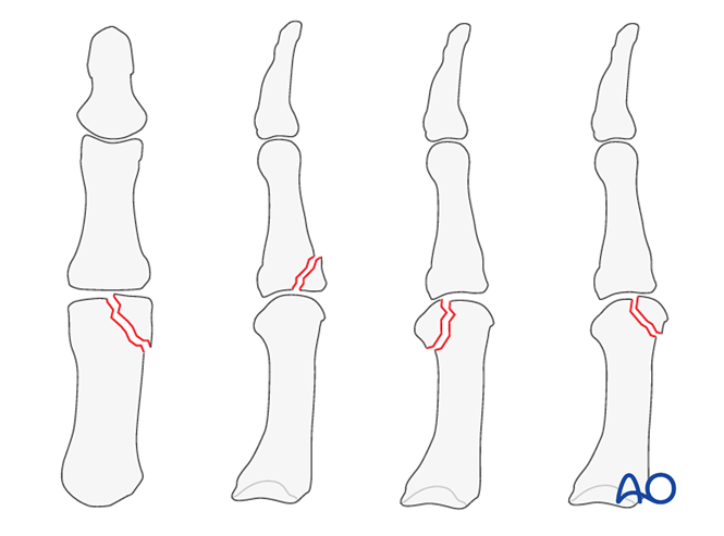 Dorsal approach to the metacarpophalangeal (MCP) joint of the thumb