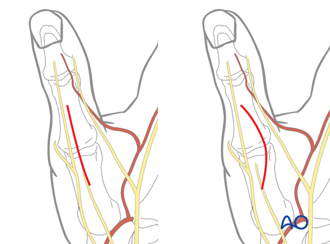 Dorsal Approach To The Metacarpophalangeal Mcp Joint Of The Thumb