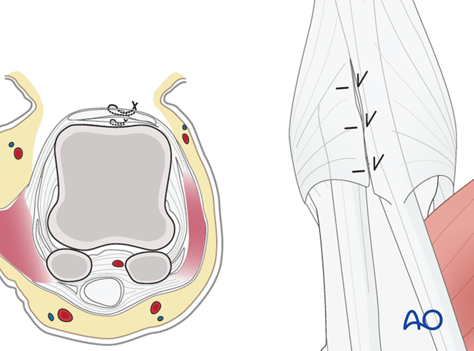 Dorsal approach to the metacarpophalangeal (MCP) joint of the thumb