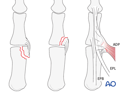 Dorsoulnar approach to the MCP joint of the thumb
