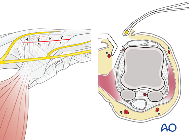 Dorsoulnar approach to the MCP joint of the thumb