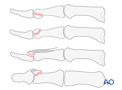 Dorsal approach to the IP joint of the thumb