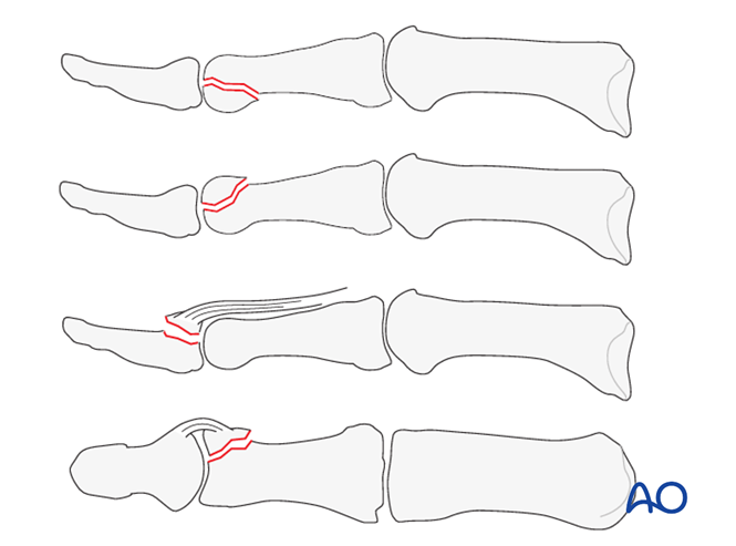 Dorsal approach to the IP joint of the thumb