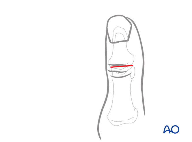 Dorsal approach to the IP joint of the thumb