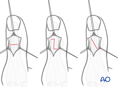Dorsal approach to the IP joint of the thumb