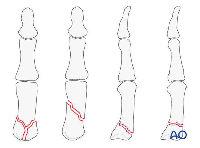 Dorsal approach to the thumb metacarpal