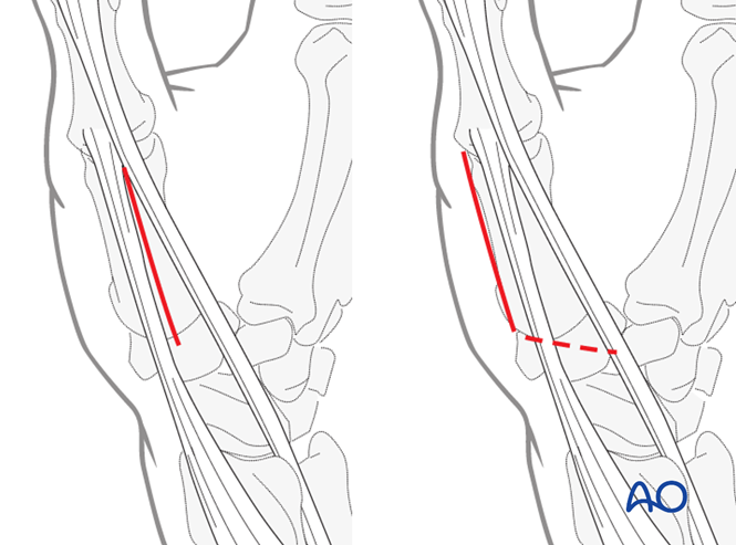 Dorsal approach to the thumb metacarpal