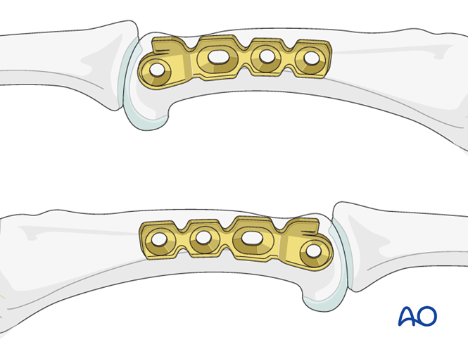 Minicondylar bridge plate fixation for Proximal phalanx, metaphyseal ...