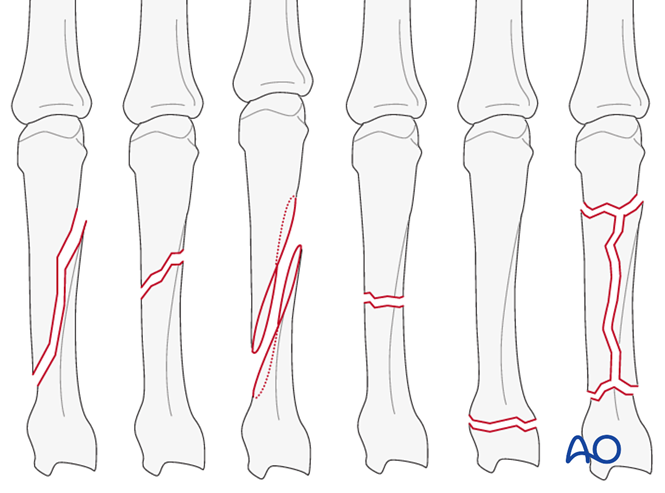 Dorsal approach to metacarpals