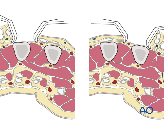 Dorsal approach to metacarpals