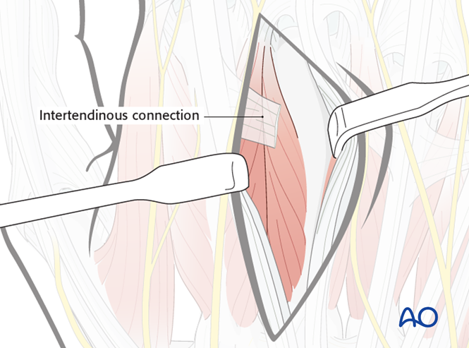 Dorsal approach to metacarpals