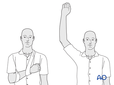 K-wire fixation for Distal phalanx, distal and shaft, multifragmentary