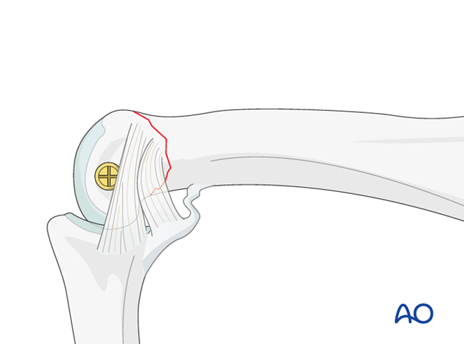 Lag screw fixation for Proximal phalanx, articular (head), oblique
