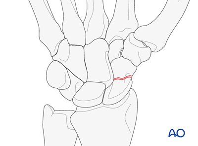 Scaphoid, proximal pole