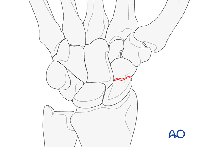 Scaphoid, proximal pole