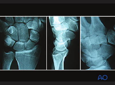 Scaphoid, proximal pole