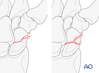 Palmar approach to the scaphoid