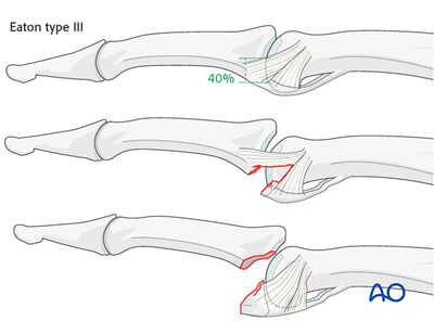Proximal, collateral ligament avulsion
