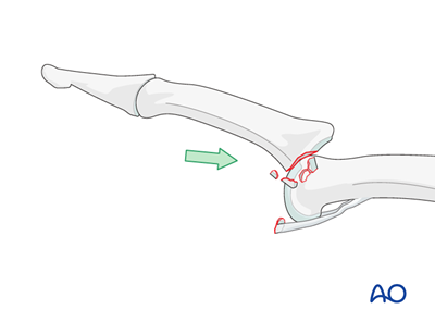 Proximal, collateral ligament avulsion
