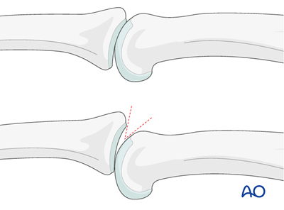 Proximal, volar plate avulsion
