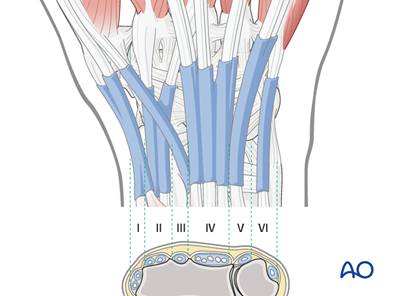 Combined approach to perilunate fractures and dislocations