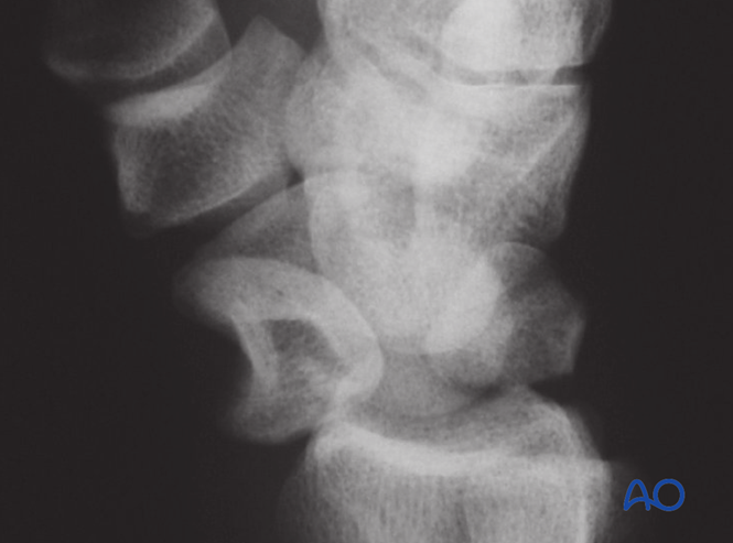 Combined approach to perilunate fractures and dislocations