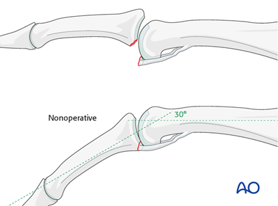Proximal, volar plate avulsion