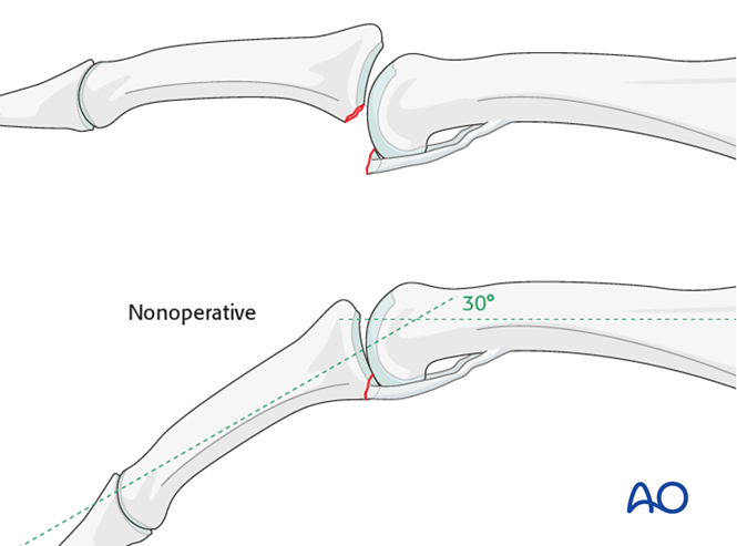 Proximal, collateral ligament avulsion