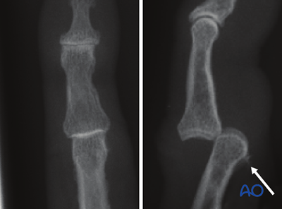 Proximal, collateral ligament avulsion
