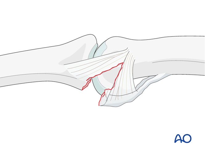 Proximal, volar plate avulsion
