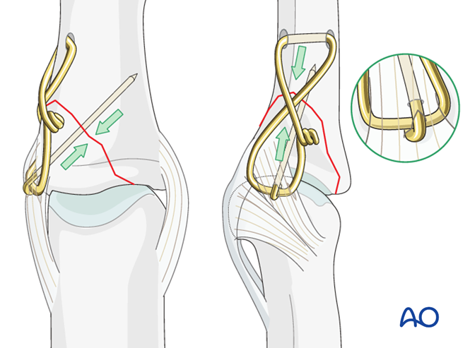 Tension-band wiring for Proximal, collateral ligament avulsion
